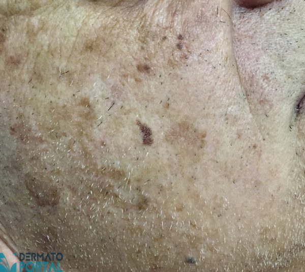 Dermatoscopia – DermatoPortal